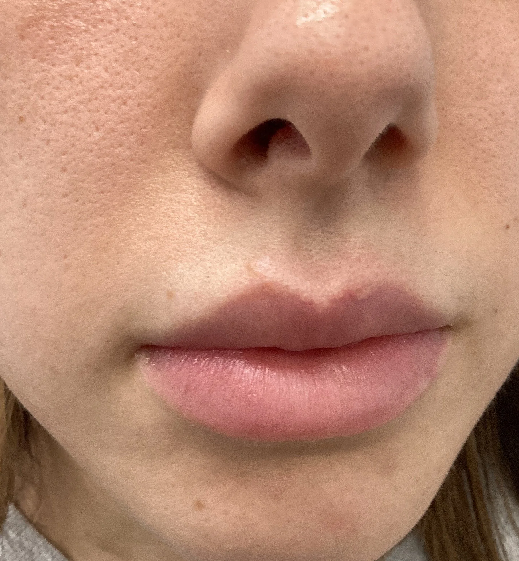 Benign Skin Lesion Removal in Toronto
