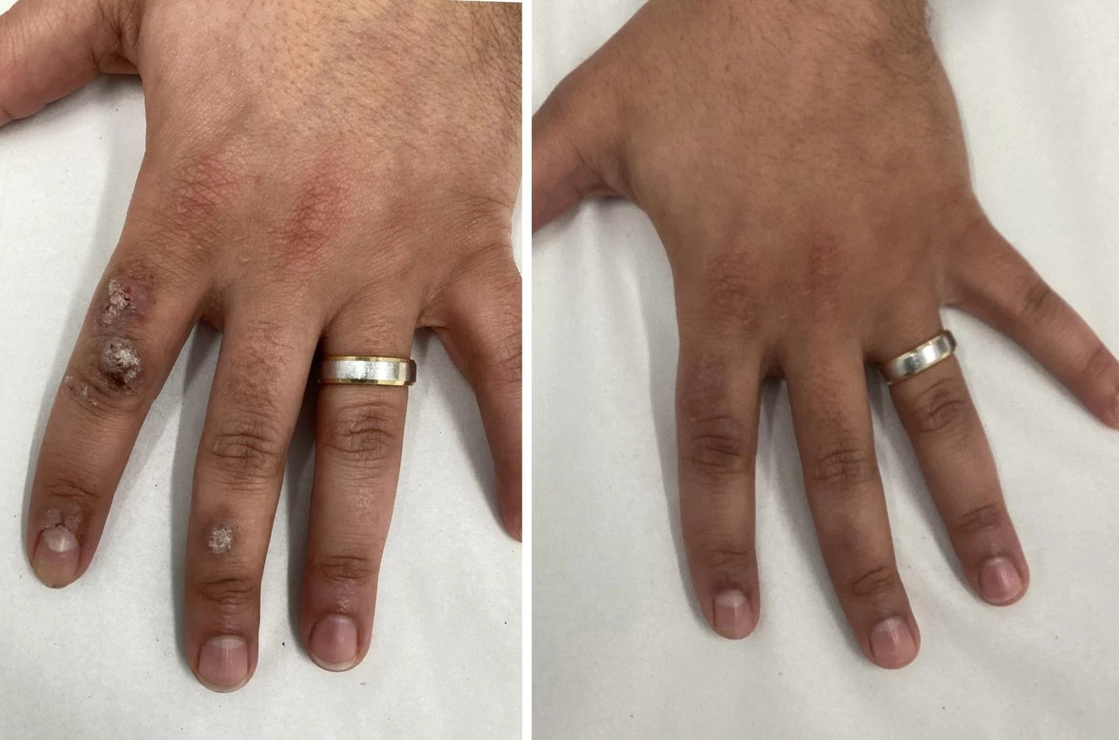 Wart Removal Treatments in Toronto | Laser & Electrocautery Options