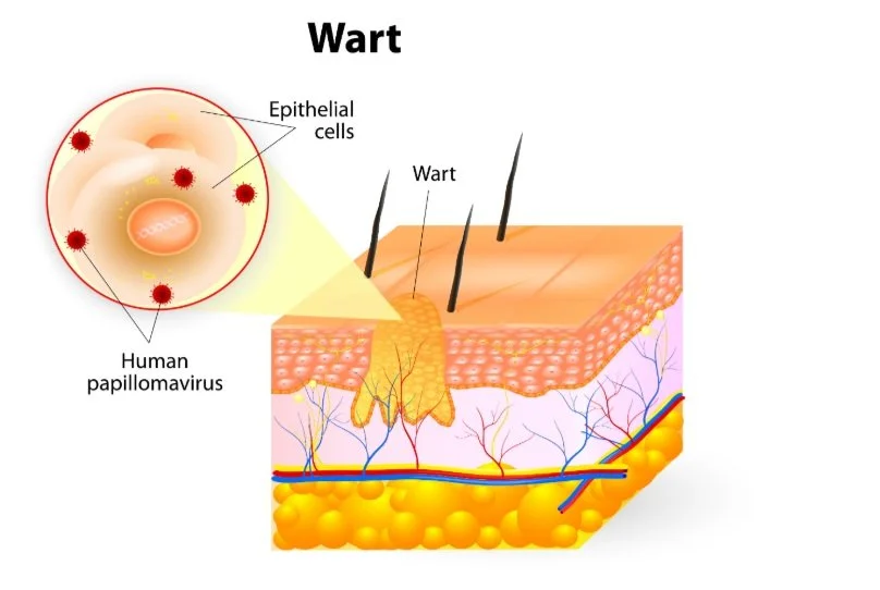 Wart Removal Treatments in Toronto | Laser & Electrocautery Options