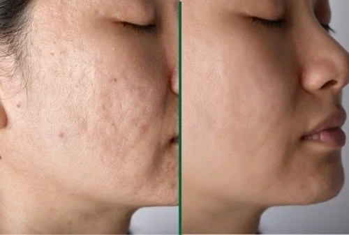Microdermabrasion in Toronto | Smooth & Brighten Skin