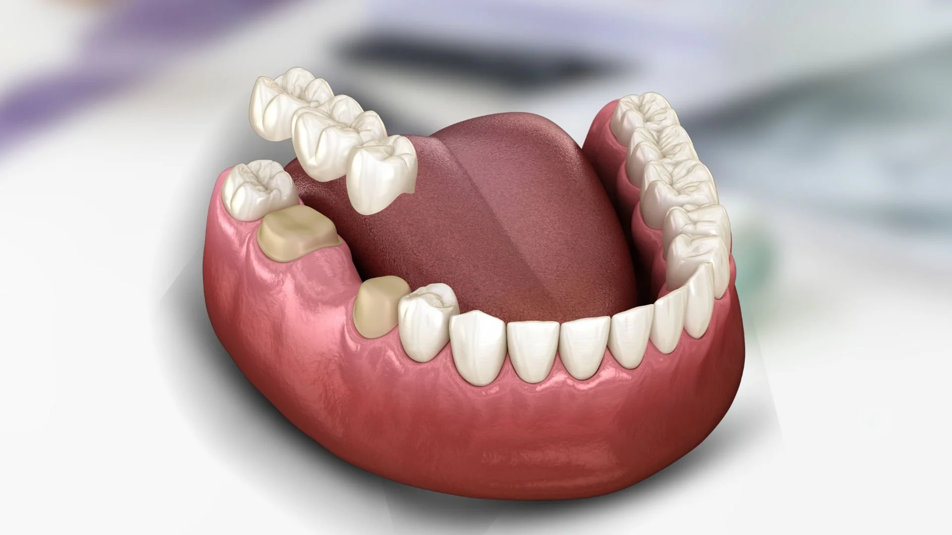 Dental Bridges in San Francisco California — Smile Design