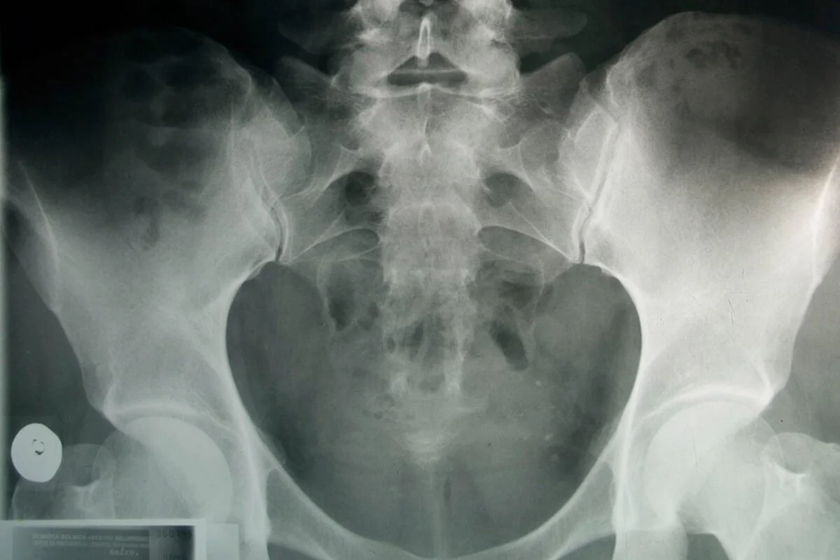 Slipped Upper Femoral Epiphysis — Reading Children's Orthopaedic Unit