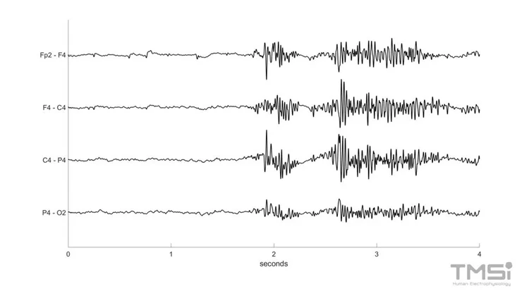 TMSi — an Artinis company — Common physiological EEG artifacts