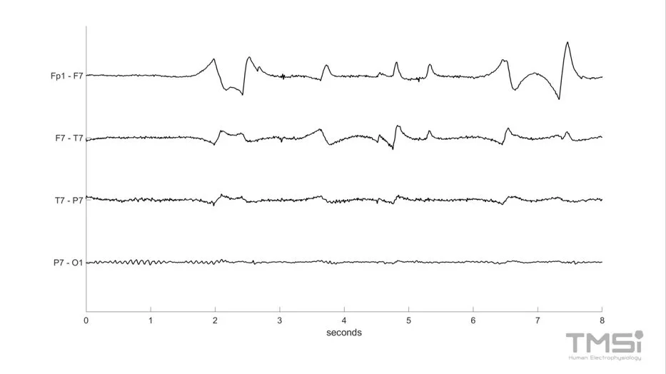 TMSi — an Artinis company — Common physiological EEG artifacts