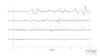 TMSi — an Artinis company — Common physiological EEG artifacts