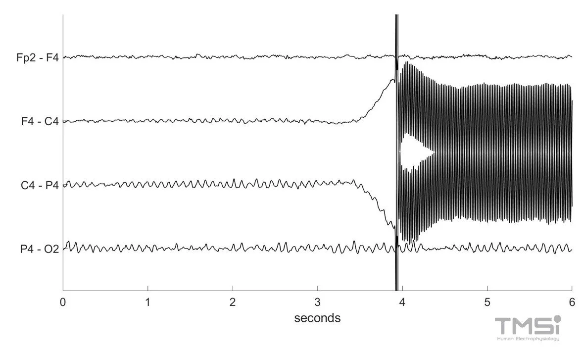 TMSi — an Artinis company — Common non-physiological (external) EEG ...