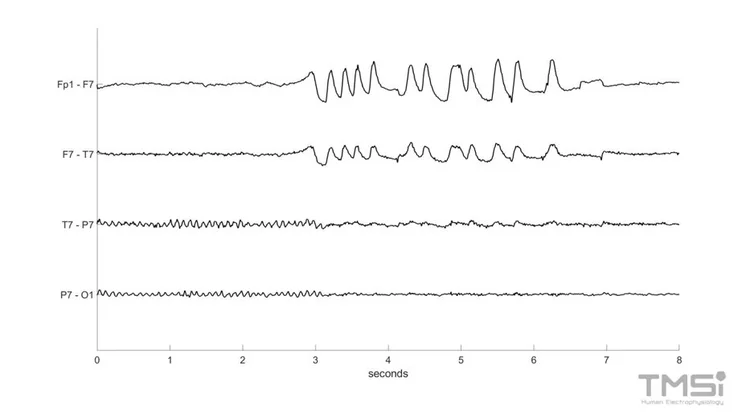 TMSi — an Artinis company — Common physiological EEG artifacts