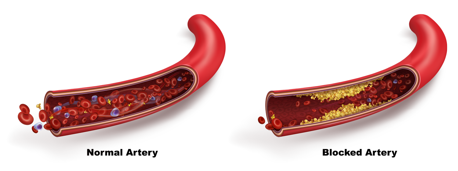 Coronary | Nventric | Medical Devices