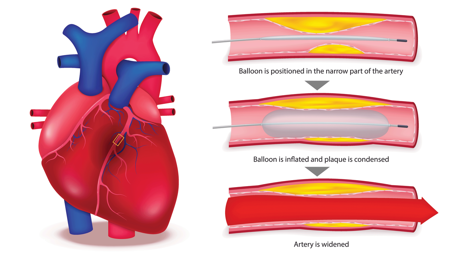 Coronary | Nventric | Medical Devices