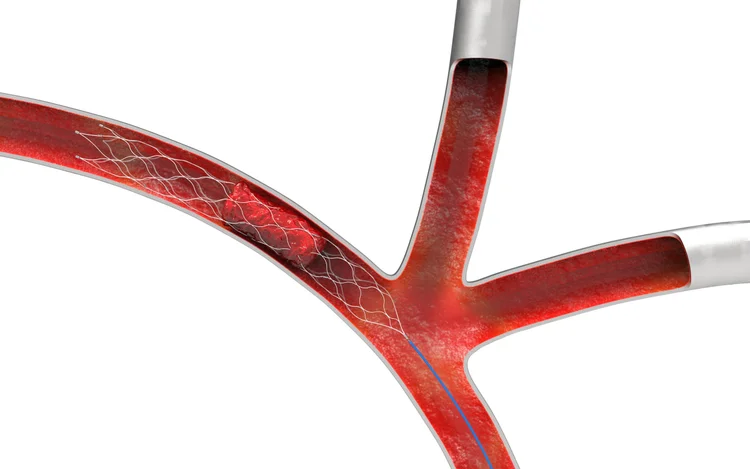 Neurovascular | Nventric | Medical Devices