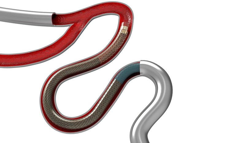 Neurovascular | Nventric | Medical Devices