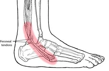 Conditions Peroneal Tendinopathy — Adrian Talia