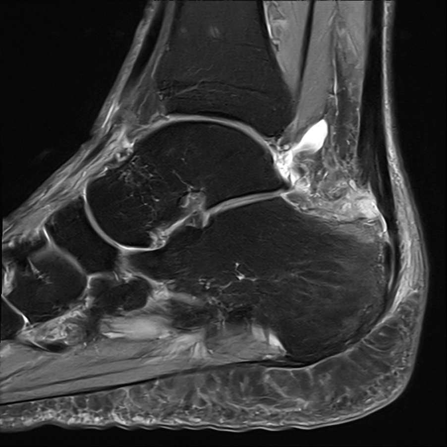 Conditions Achilles Tendinopathy — Adrian Talia