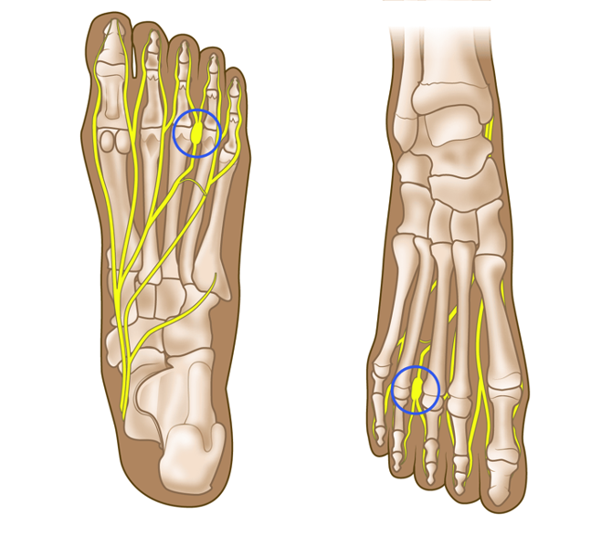 Procedures Morton's Neuroma — Adrian Talia