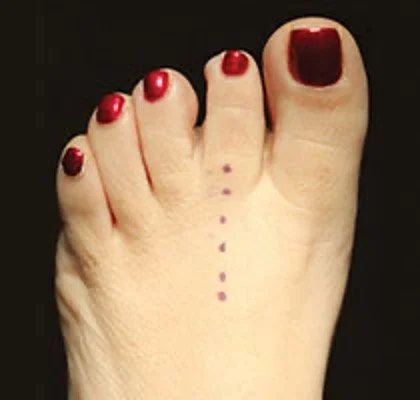 Procedures Plantar Plate Repair — Adrian Talia