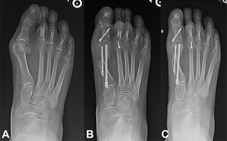 Procedures Hallux Valgus Correction (MIS) — Adrian Talia