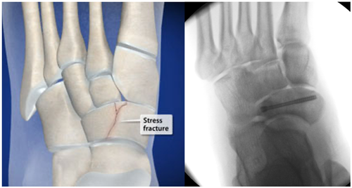 Procedures Navicular Fractures — Adrian Talia