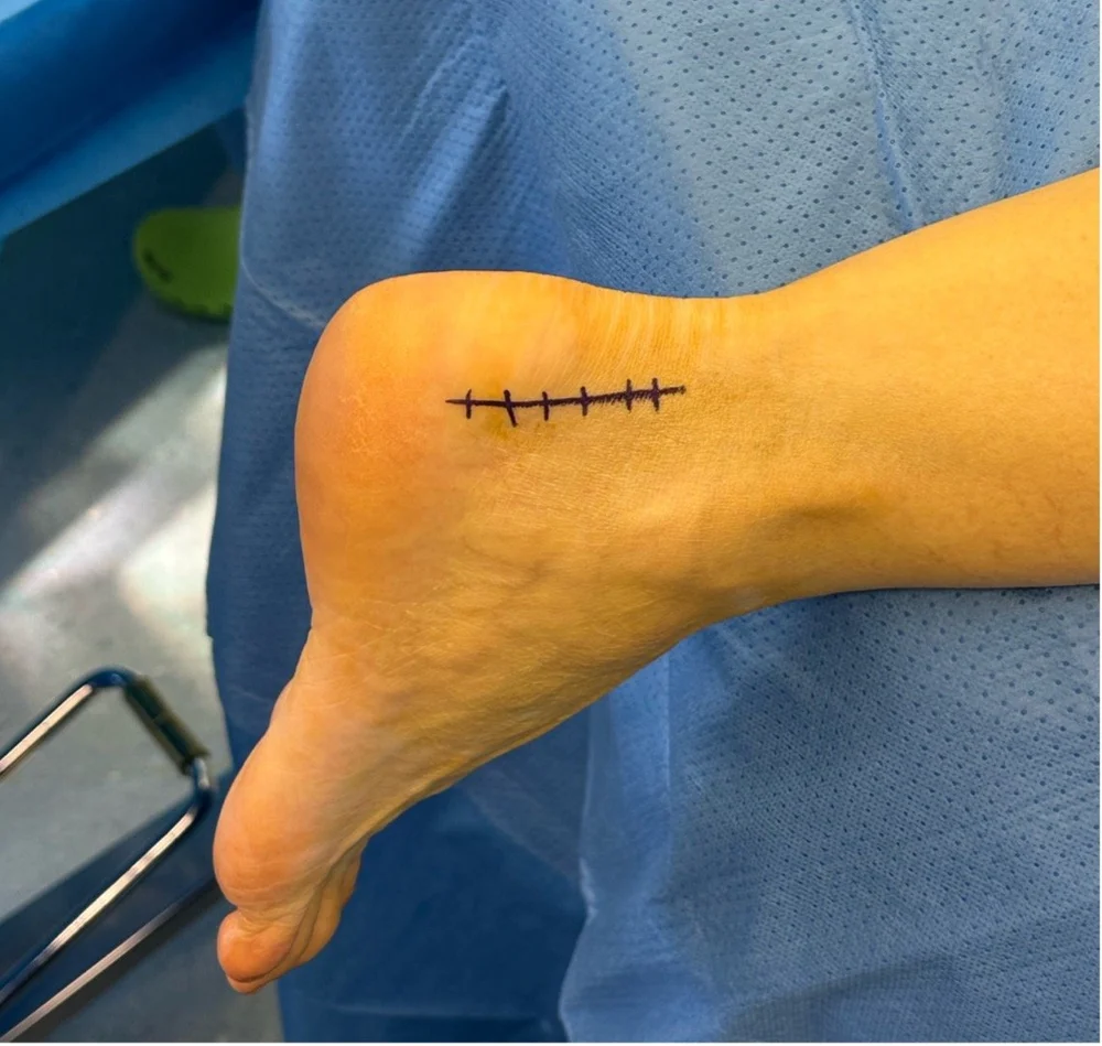 Procedures Achilles reconstruction surgery — Adrian Talia