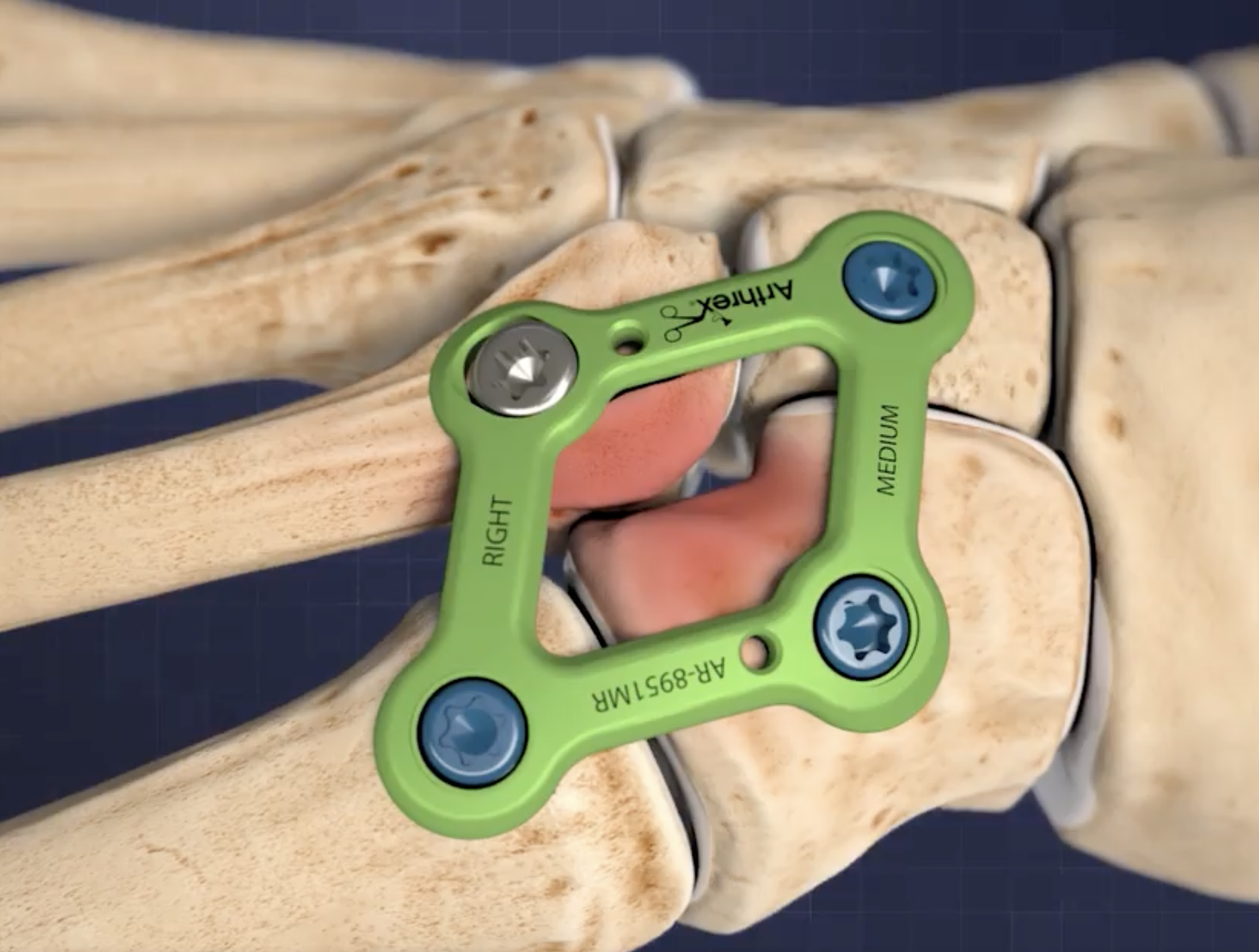 Procedures Lisfranc injury fixation — Adrian Talia