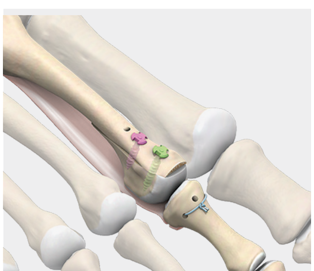 Procedures Plantar Plate Repair — Adrian Talia