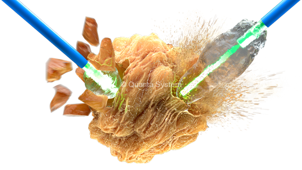 MEDILAZE | QUANTA SYSTEMS | CYBER HO MAGNETO 150W