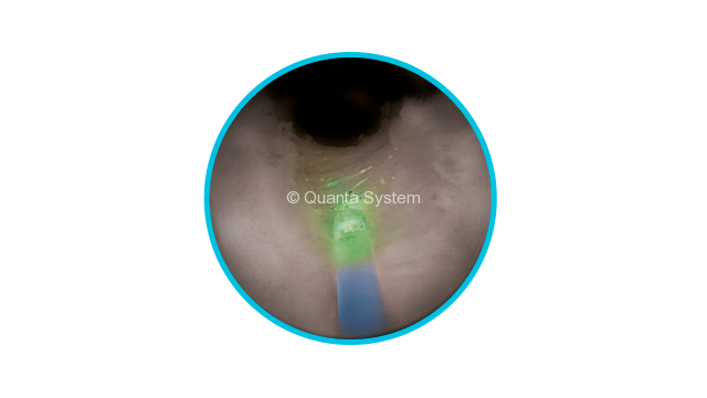 MEDILAZE | QUANTA SYSTEMS | CYBER HO MAGNETO 150W