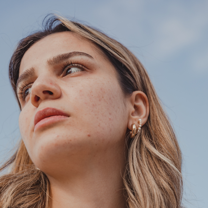 Scar Treatment Options Karratha - Acne & Surgical