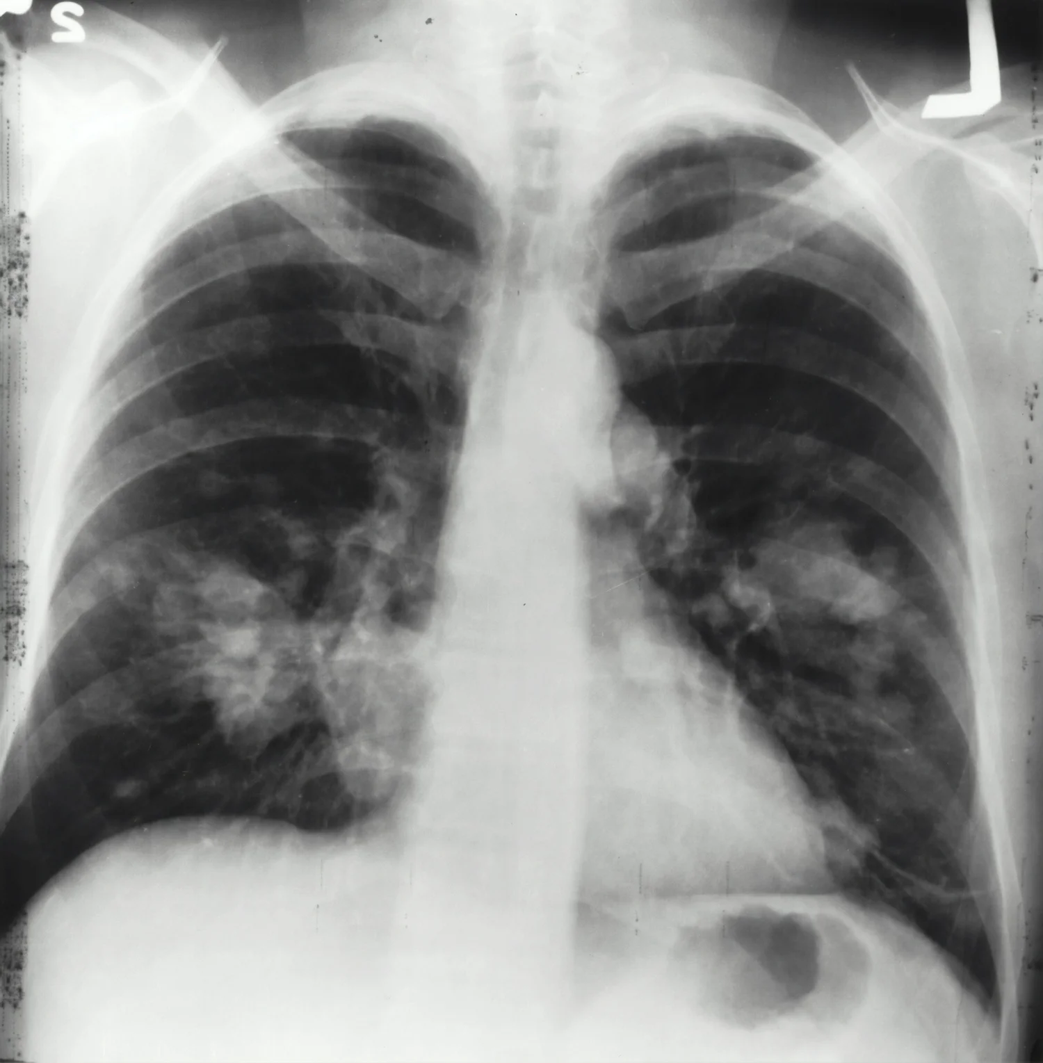 Pulmonary Disease and Dysphagia: What SLPs need to know — The Dysphagia ...