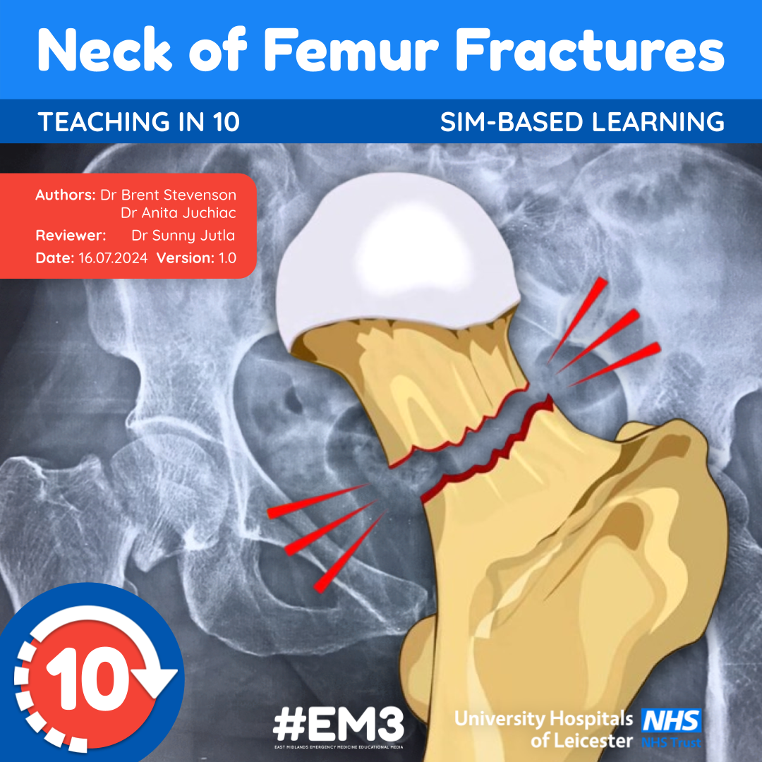 Neck of Femur Fractures — EM3