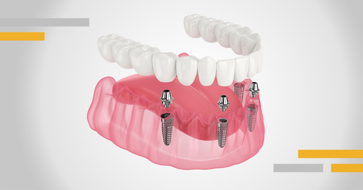 All-on-4 Implants: What to Expect Before, During, and After Your ...