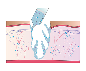 PolarityBio - Advancing Regenerative Skin Therapy for Chronic Wounds