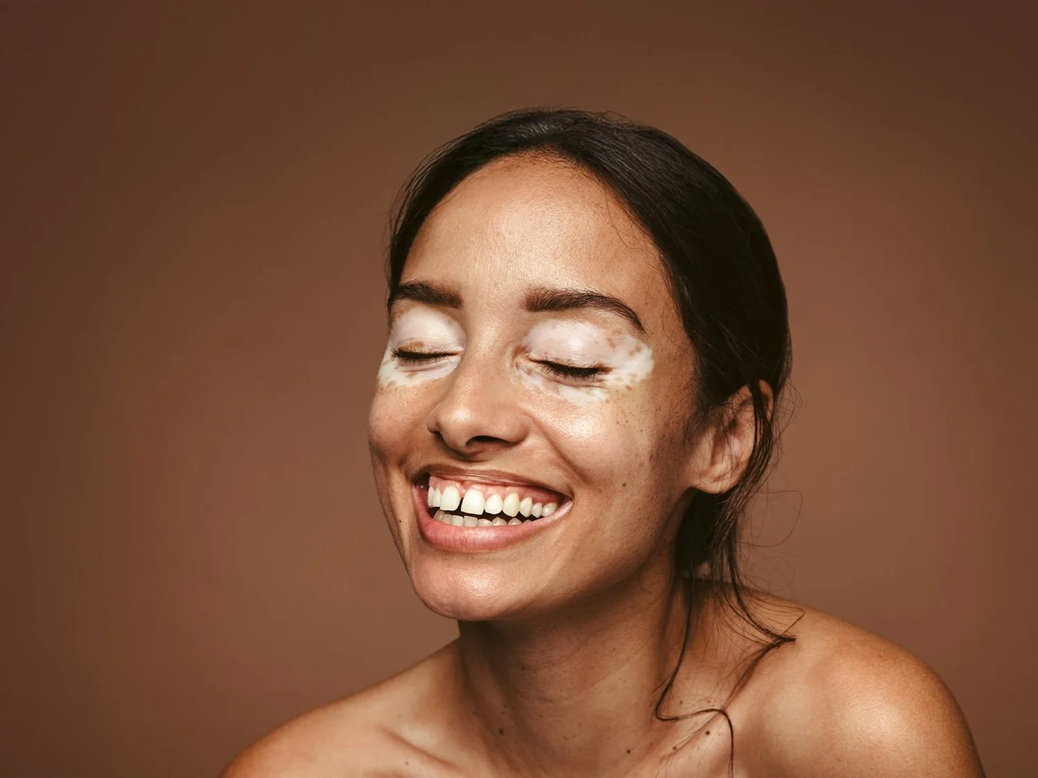 Vitiligo Treatment | Graceville | Brisbane | — Expert Dermatology care ...