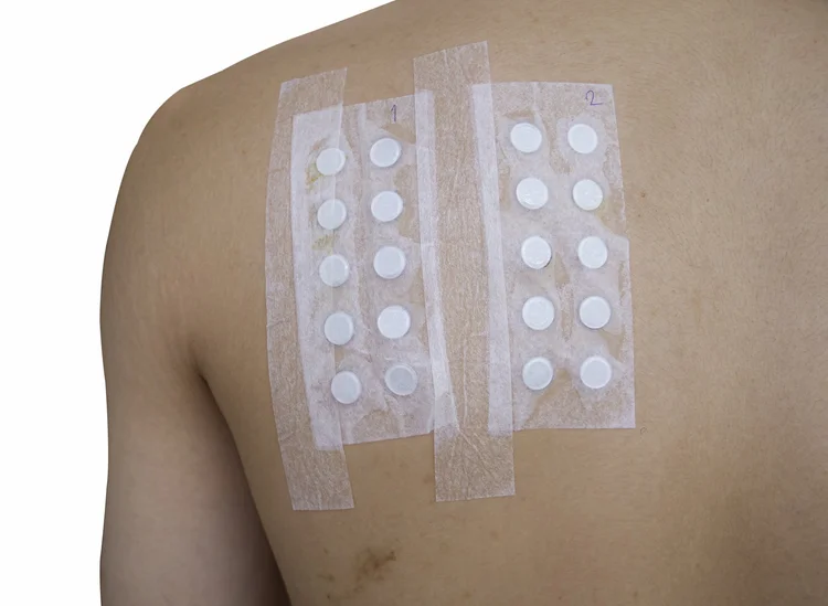 Allergy Patch Testing — Shades Dermatology | Graceville, Brisbane