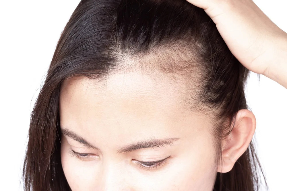 Androgenetic Alopecia Treatment — Shades Dermatology | Dr Heba Jibreal ...