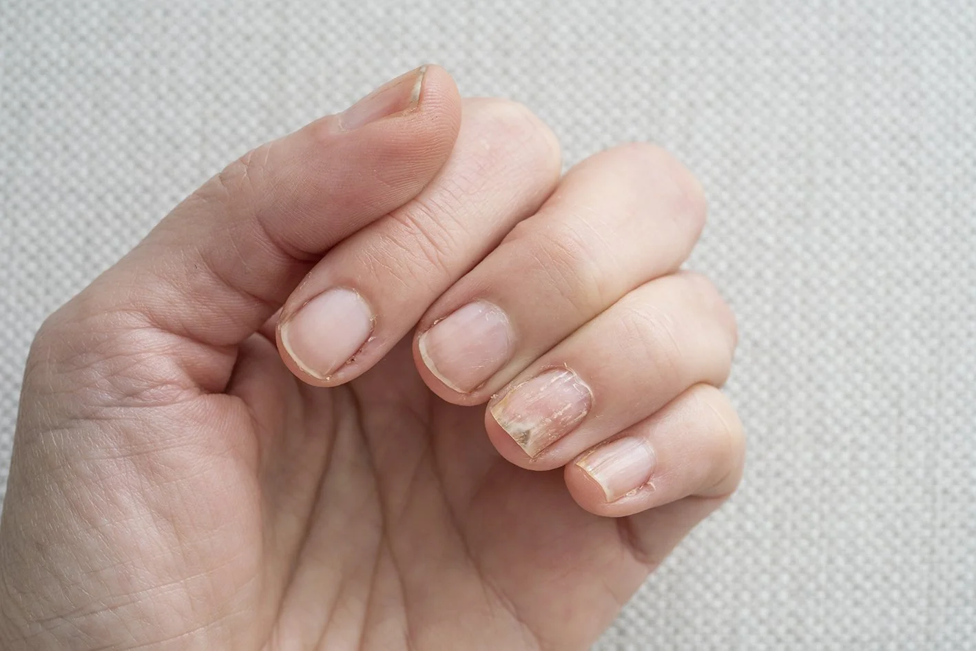 Nail Disorders — Shades Dermatology | Dr Heba Jibreal | Dr Devita ...
