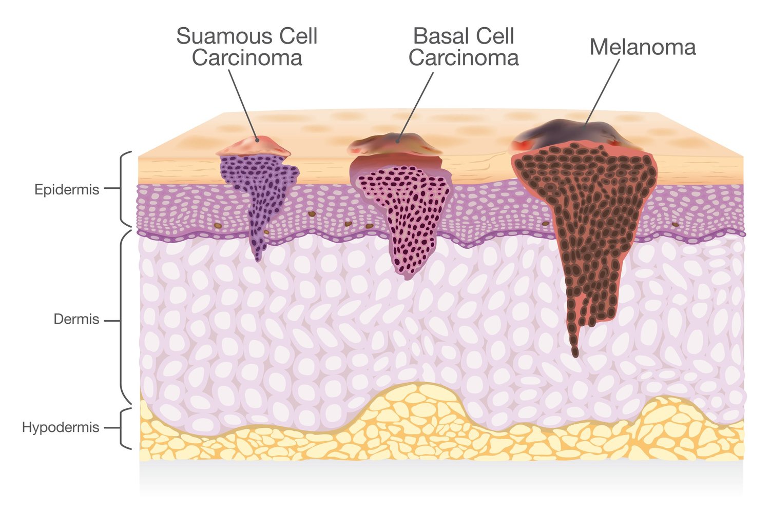 About Skin Cancer Treatments | Explore Skin Cancer Solutions—Book Today ...