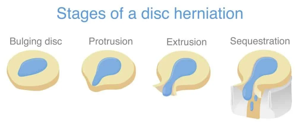 Herniated Disc on Imaging — Regain Performance Physical Therapy