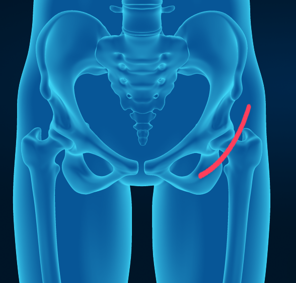 Anterior Total Hip Replacement — Drew Ratner MD, MBA