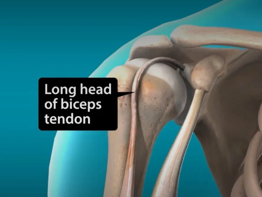 Biceps Tenotomy vs Tenodesis — Drew Ratner MD, MBA