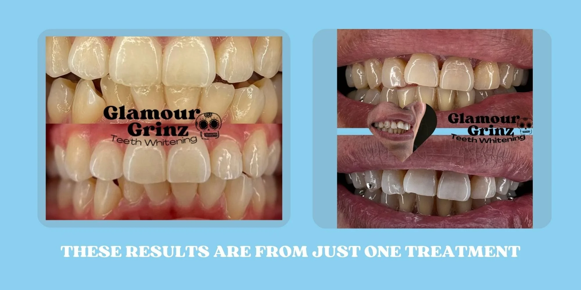 Glamour Grinz – Teeth Whitening & Tooth Gemz