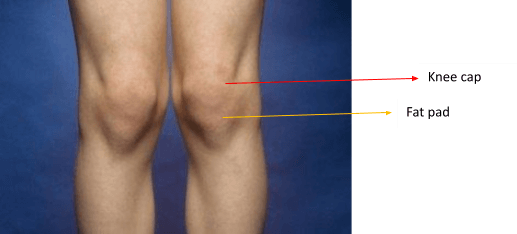 Understanding Hoffa’s Fat Pad Syndrome