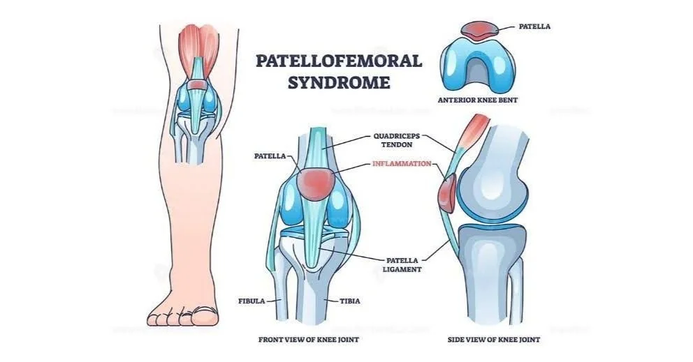 Why Patellofemoral Pain Becomes Chronic & Rehab