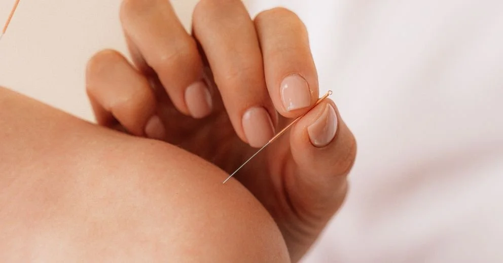 How Dry Needling Works: Benefits & What to Expect