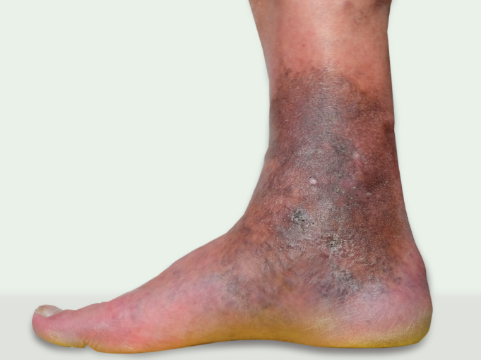Red Light Therapy for Venous Leg Ulcers — Medford Red Light Therapy