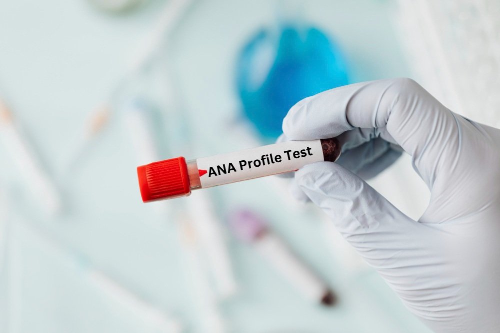 Understanding a Positive ANA Test: What It Really Means | Dr. Michelle ...