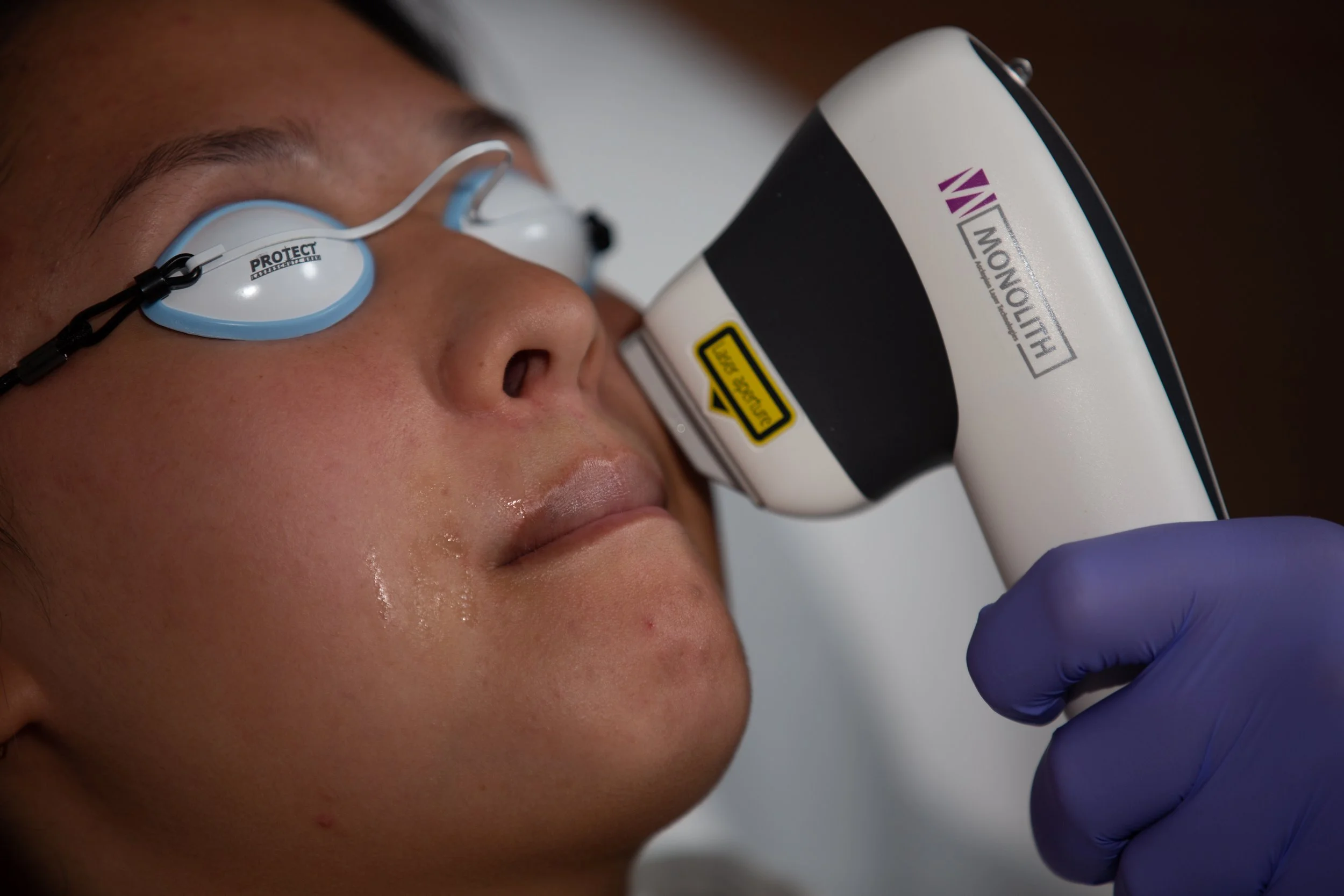 Laser Hair Removal Des Moines