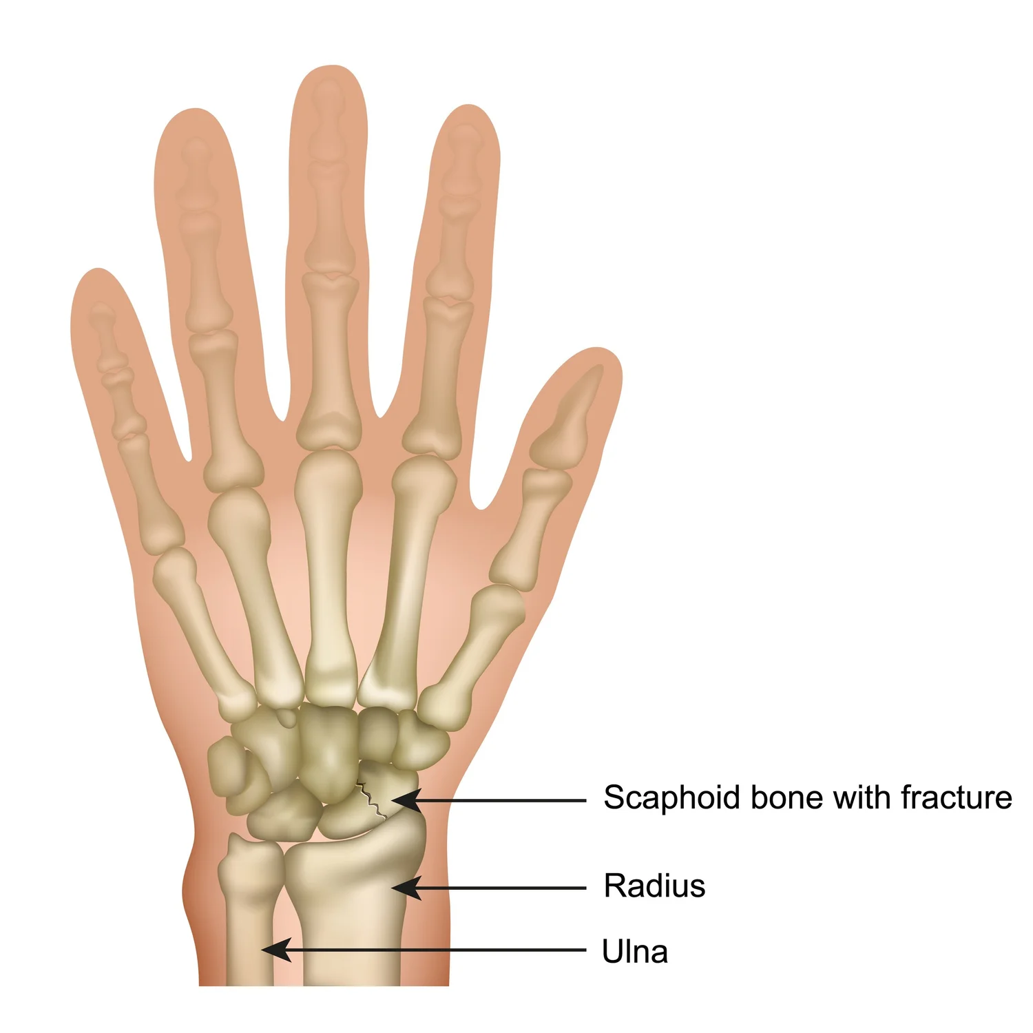Scaphoid fractures | Explore Treatment Options — Get Expert Care Today ...