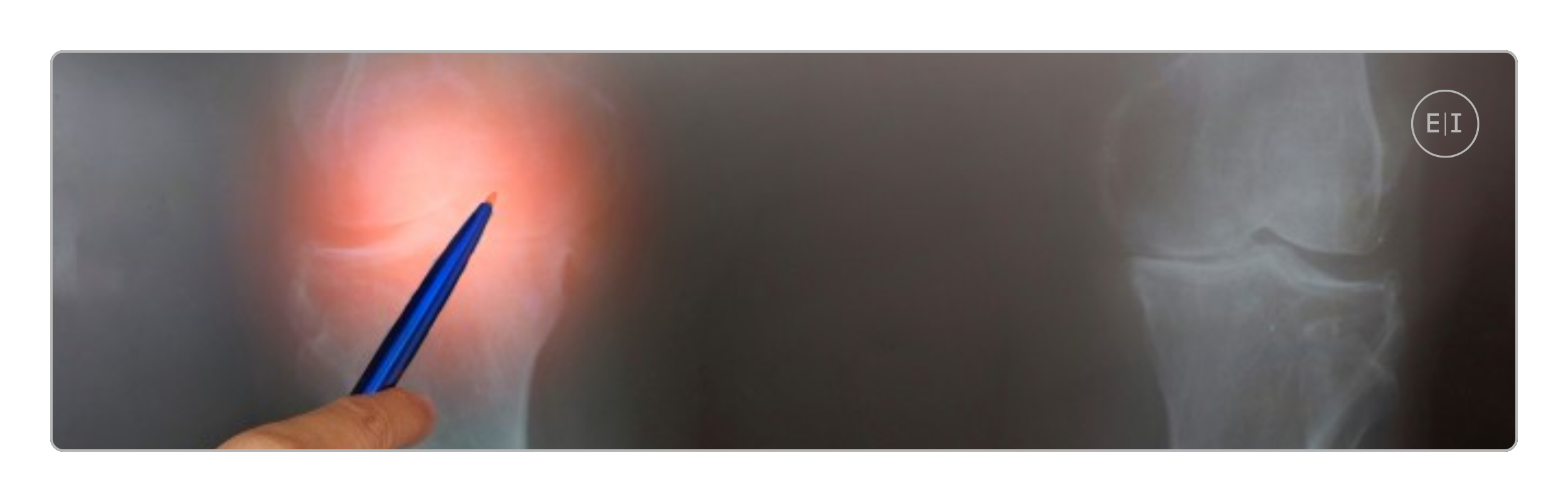 Peeking Inside Your Joints: Understanding the Arthrogram — Evolution ...