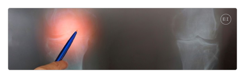 Peeking Inside Your Joints: Understanding the Arthrogram — Evolution ...