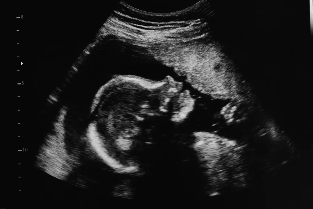 Ultrasound — Evolution Imaging